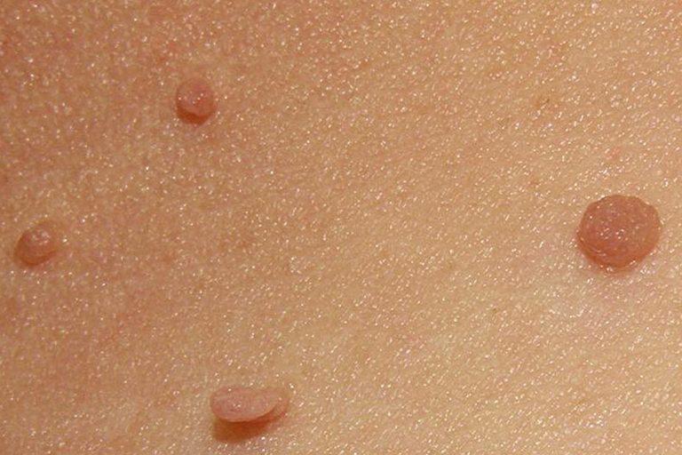 Skin tags: causes, symptoms, and removal - clearskin